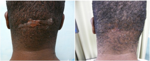 Back of head razor bumps: The who, when, and how.