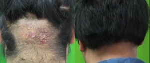 Back of Head Razor Bumps - AKN - DermHair Clinic 310-318-1500