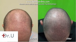 Role of body hair transplant in diffused alopecia