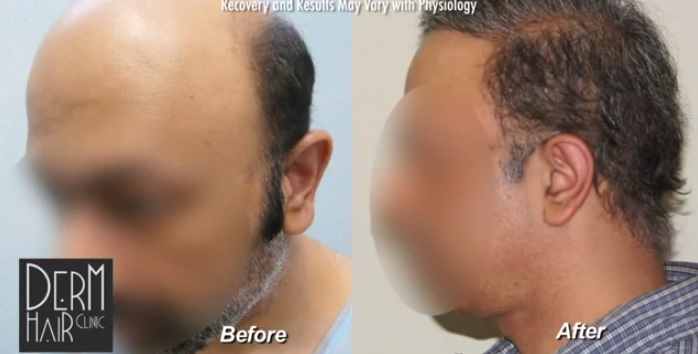 Follicular Unit Extraction 5512 Dermhair Clinic