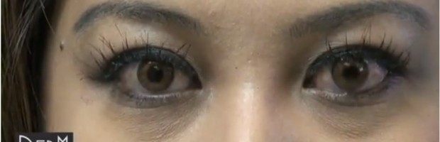 Eyelash Extensions Alternative with Eyelash Transplant - DermHair Clinic