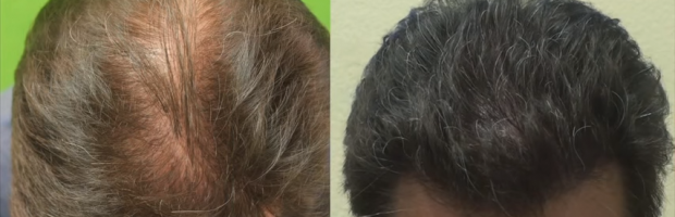 FUE Hairline Transplant and Increasing Density