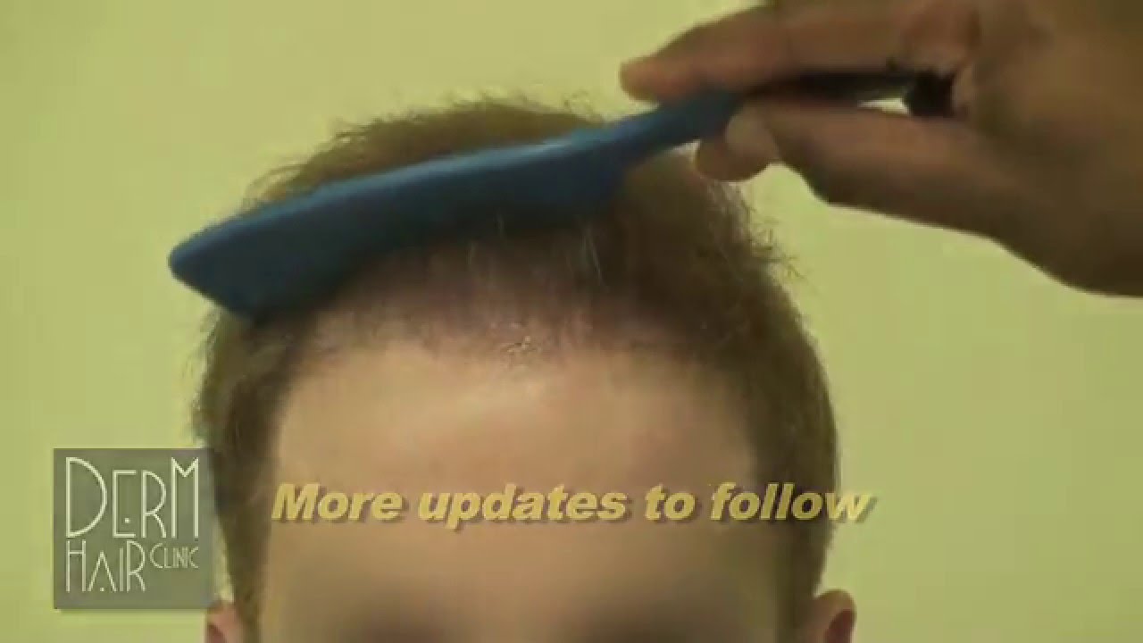 Hair Restoration Through Scalp Reduction