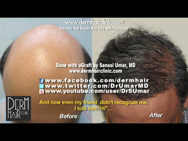 Hair Cloning - DermHair Clinic Los Angeles Call 1-310-318-1500