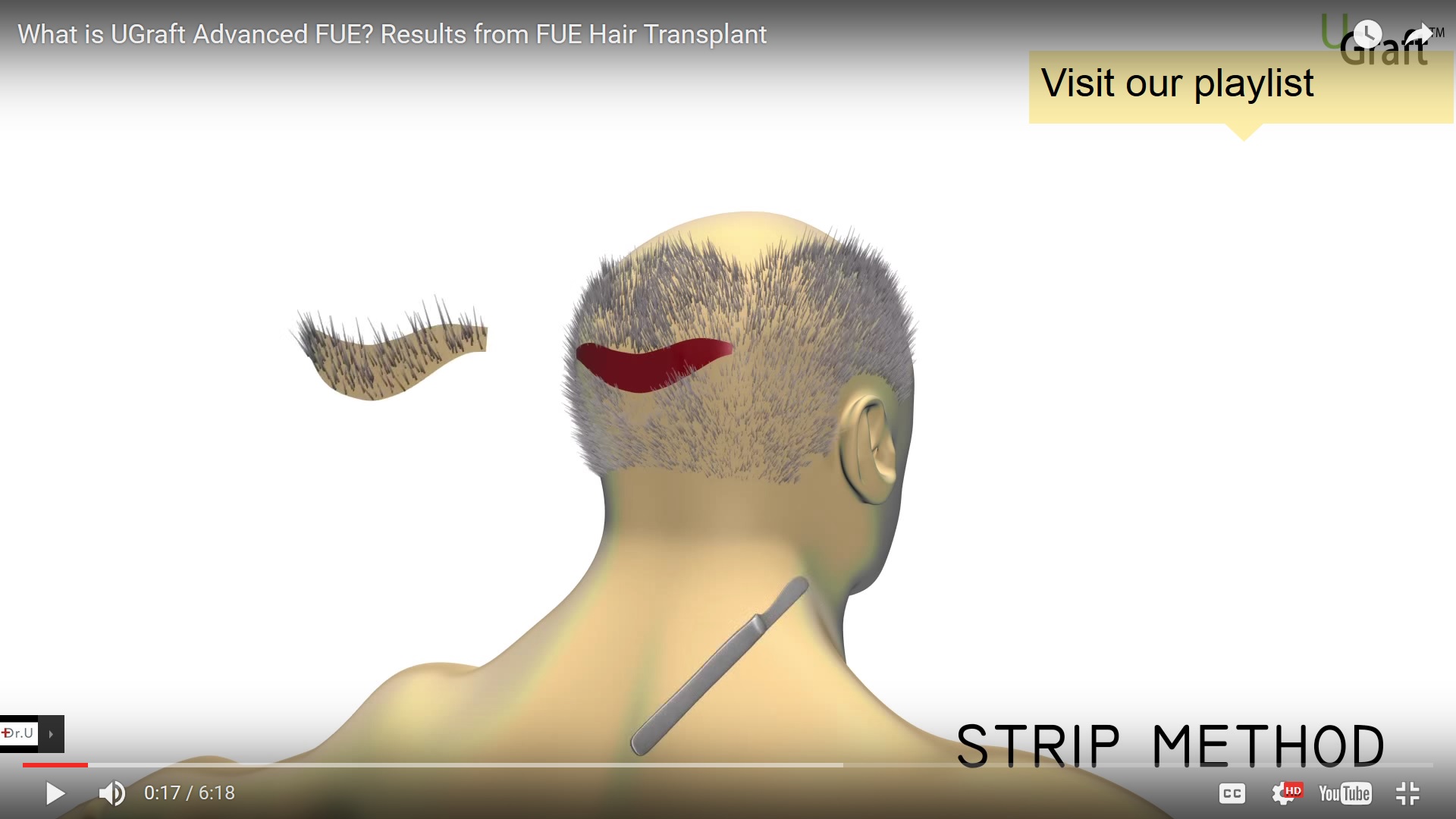 Hair Restoration - What You Should Know - DermHair Clinic Los Angeles