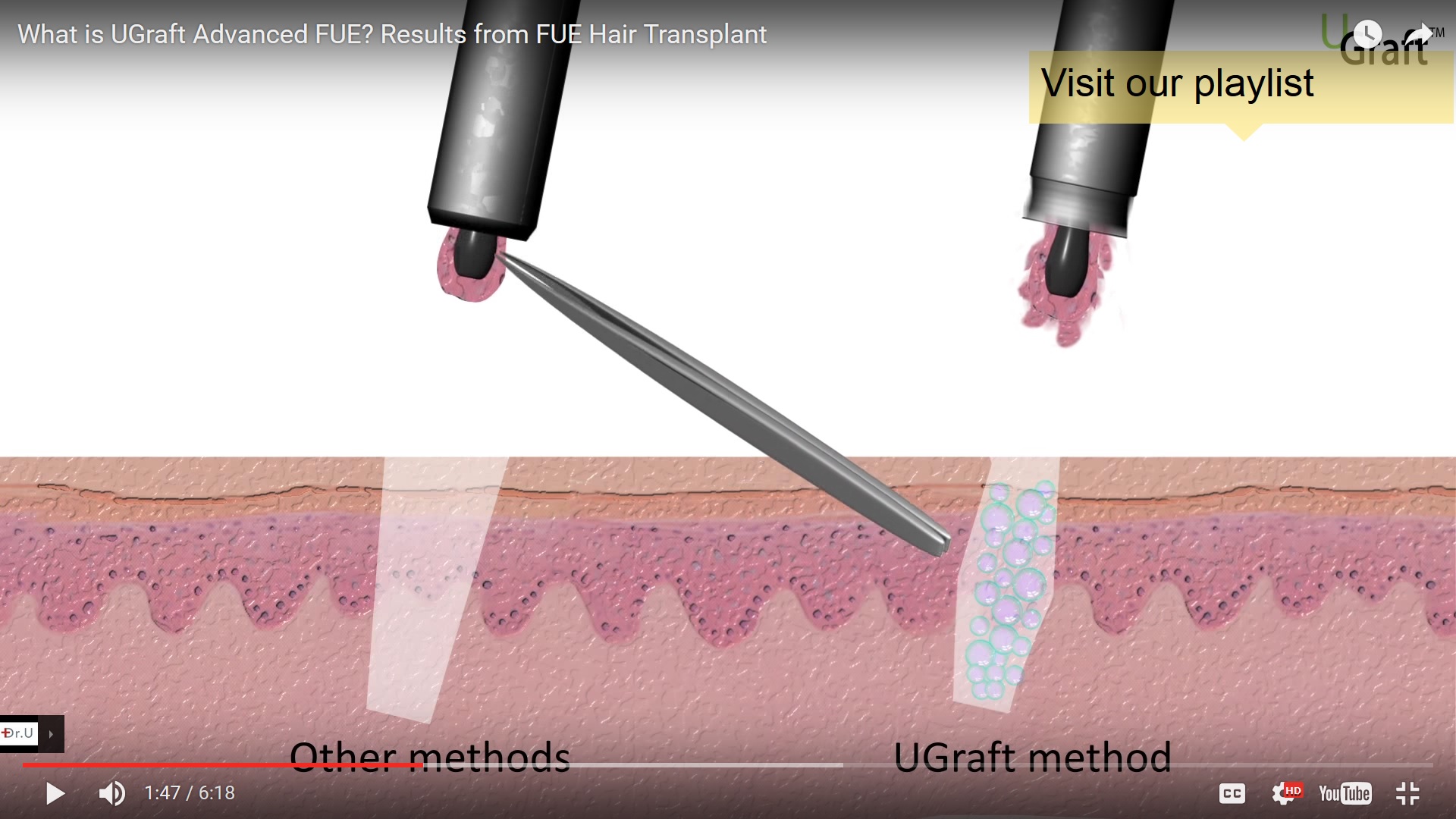 UGraft Advanced Follicular Unit Extraction for Body Hair Transplant